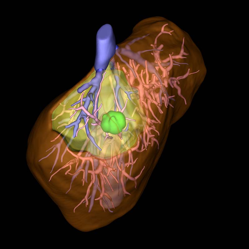 肝臓解析｜手術シミュレーション｜REVORAS
