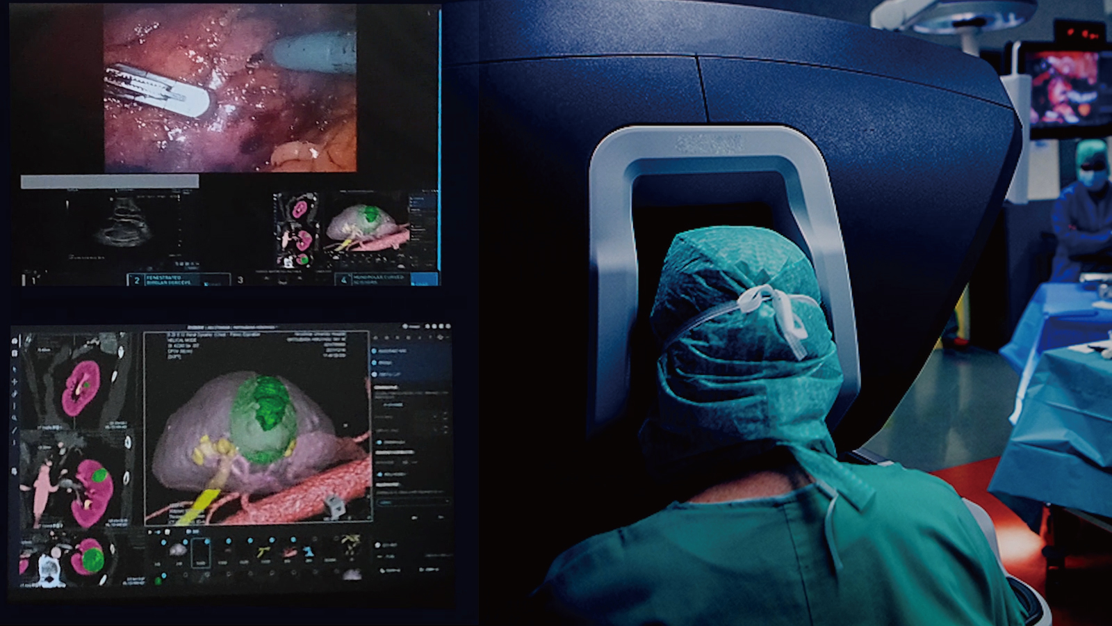 腎切除解析｜手術シミュレーション｜REVORAS