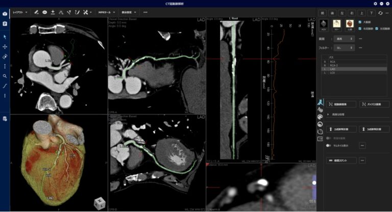 アプリケーション（心臓領域） | REVORAS