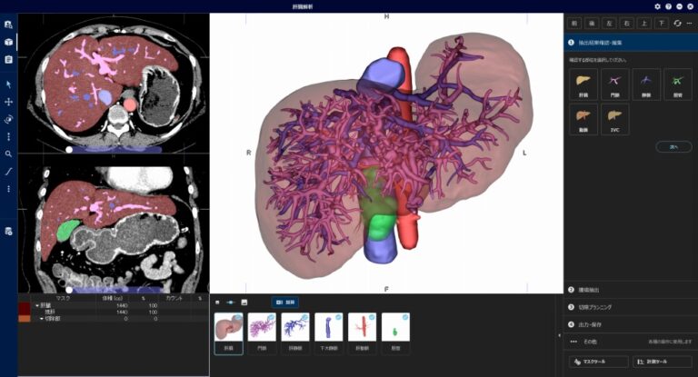 アプリケーション（腹部領域） | REVORAS