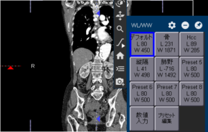 ウィンドウ幅（WW）｜医用画像用語集 | REVORAS